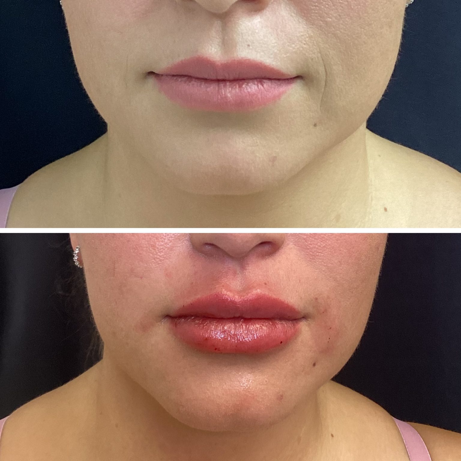 Lip Filler in Vienna Virginia - Milani MedSpa