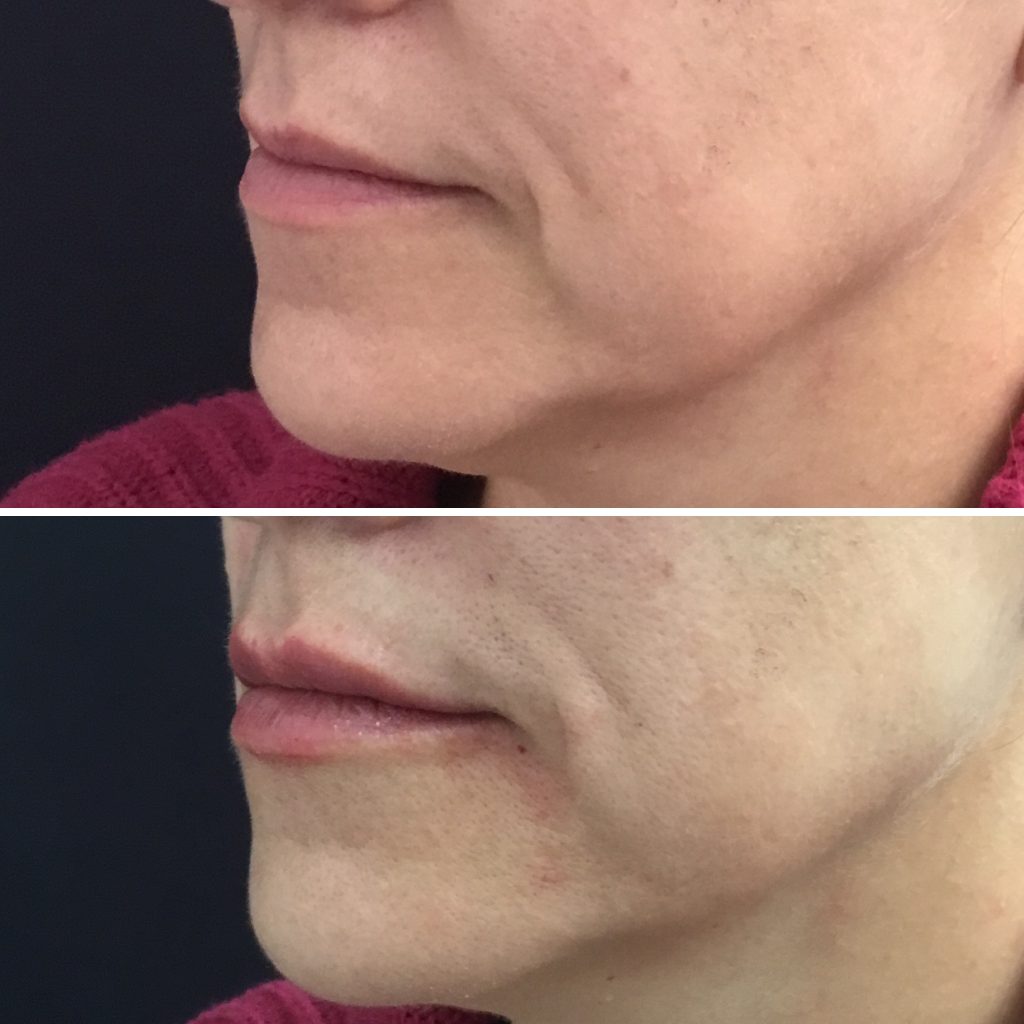 Lip Filler in Vienna Virginia - Milani MedSpa