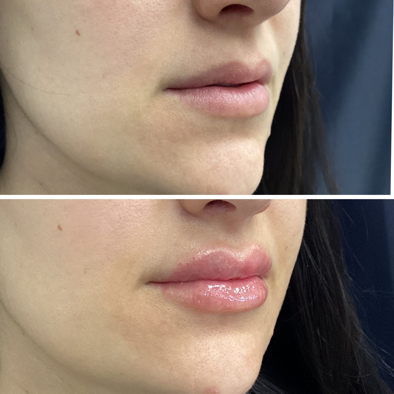 Lip Filler in Vienna Virginia - Milani MedSpa