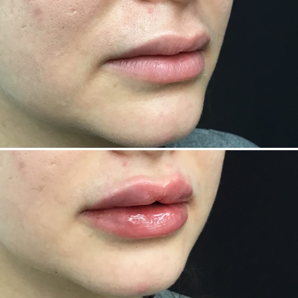 Lip Filler in Vienna Virginia - Milani MedSpa