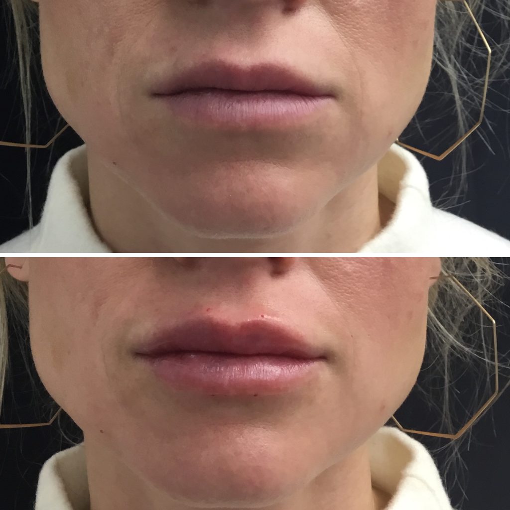 Lip Filler in Vienna Virginia - Milani MedSpa