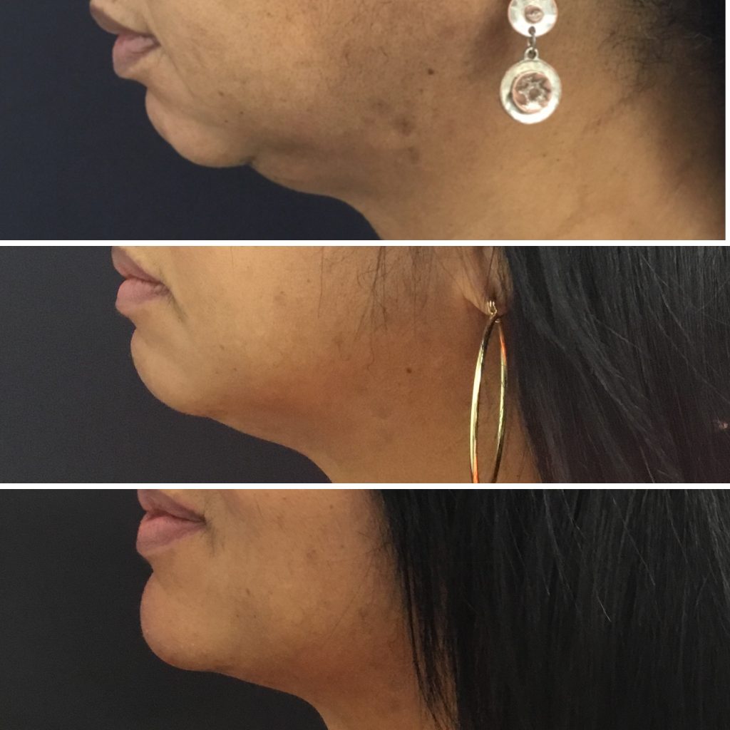 Kybella - Milani MedSpa
