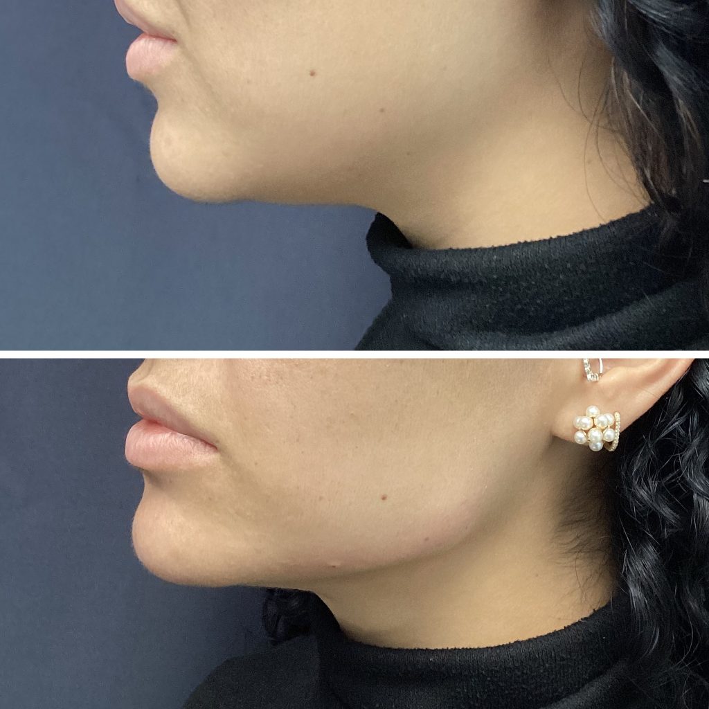 Jawline Filler in Vienna Virginia - Milani MedSpa