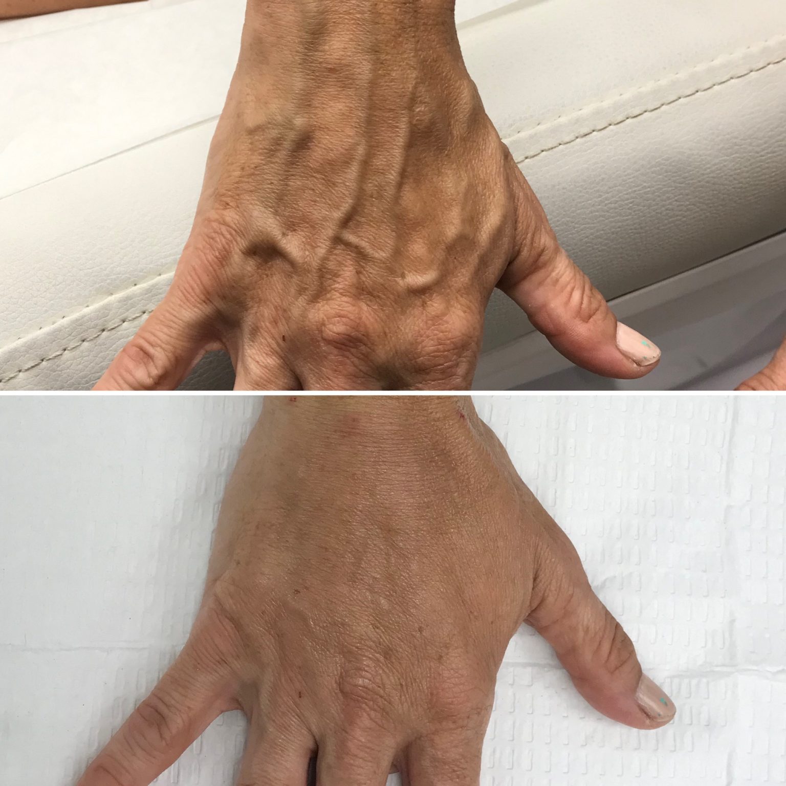 Hand Filler in Vienna Virginia - Milani MedSpa