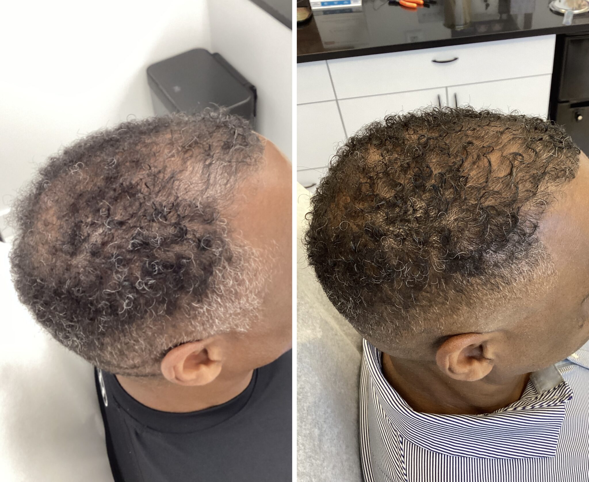 ALMA TED HAIR RESTORATION - Milani MedSpa